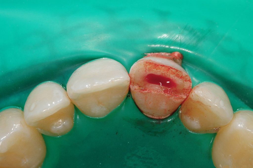 Ceramic crown for a complicated tooth fracture - Dentistry