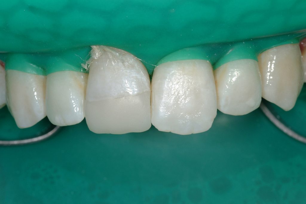 Ceramic crown for a complicated tooth fracture - Dentistry