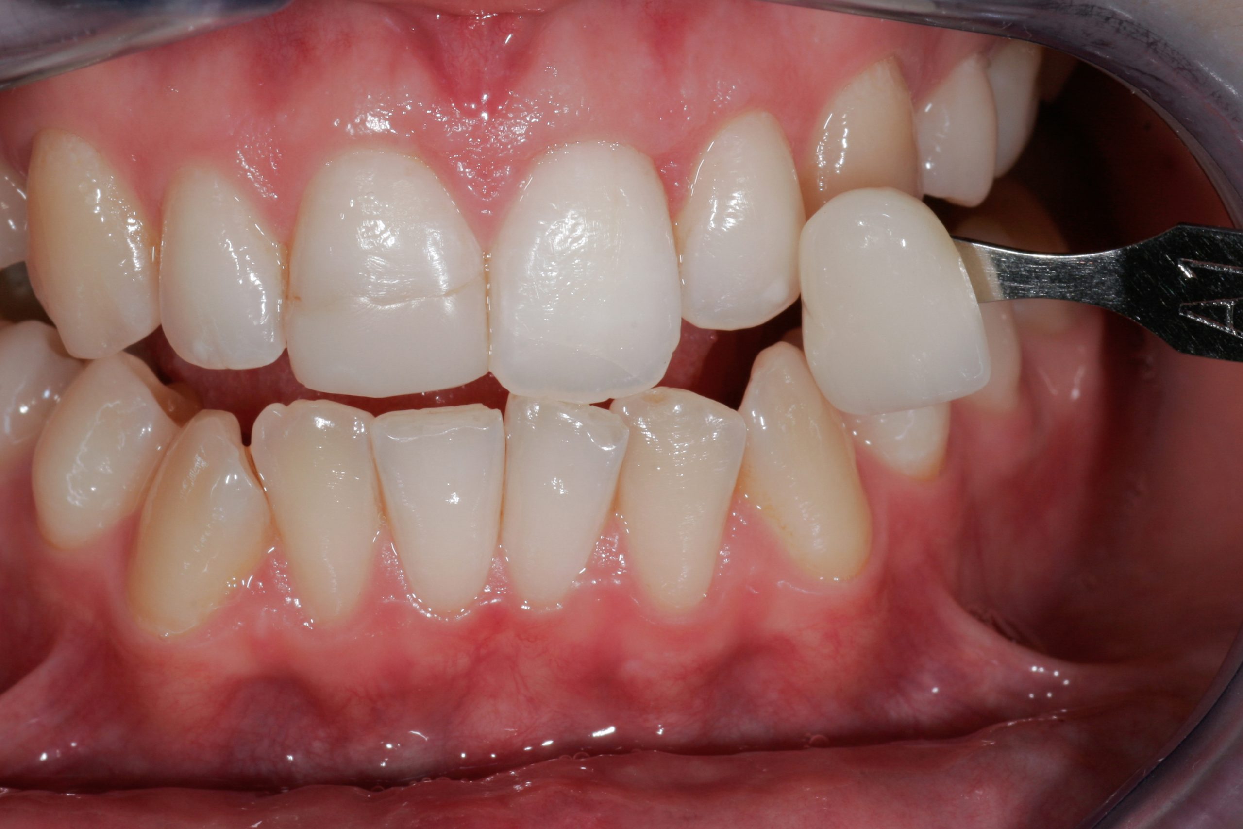 Ceramic crown for a complicated tooth fracture - Dentistry