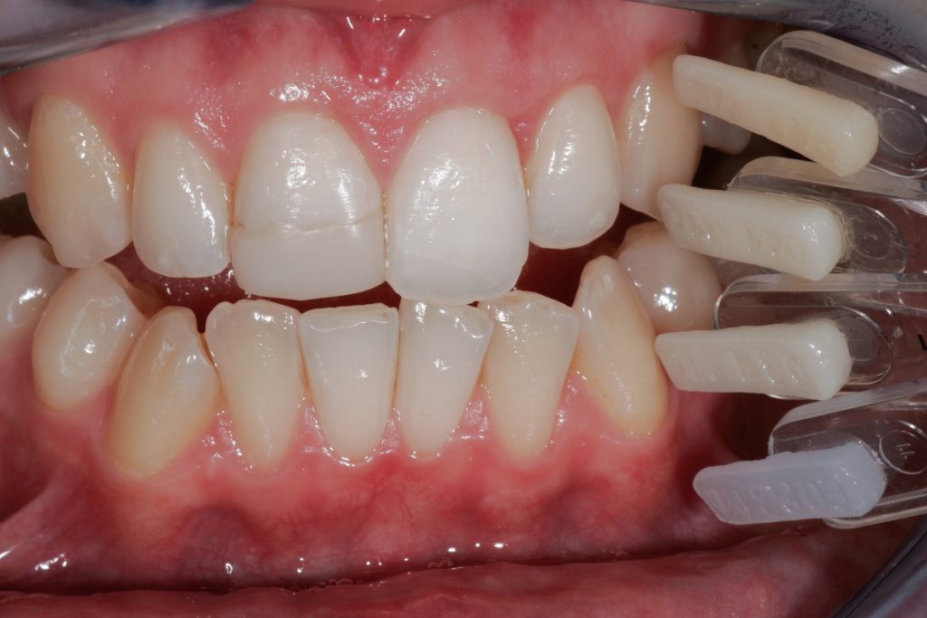 Ceramic crown for a complicated tooth fracture - Dentistry