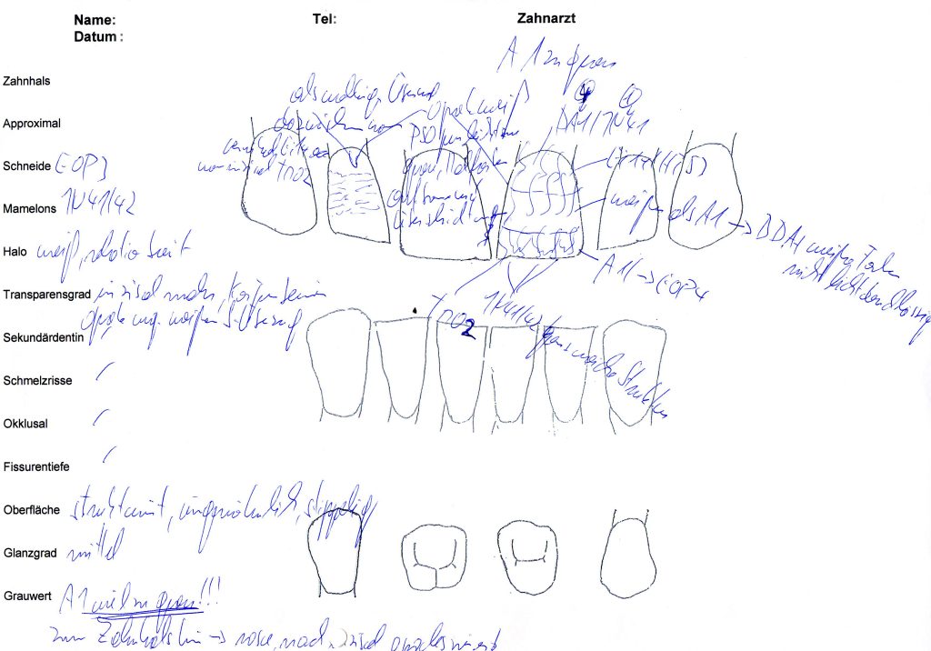 Ceramic crown for a complicated tooth fracture - Dentistry