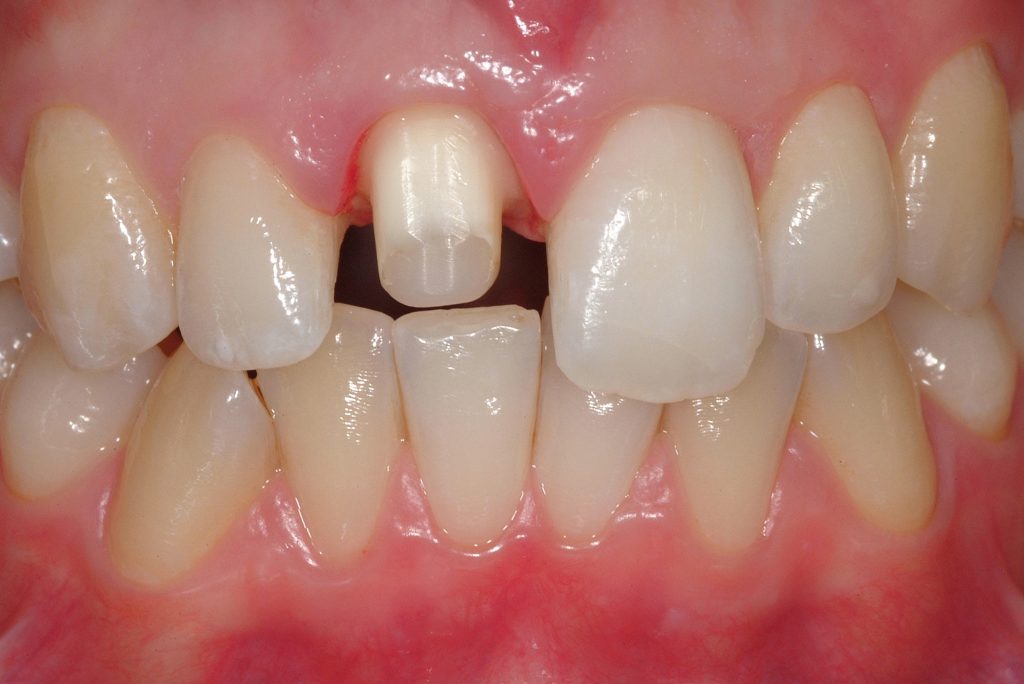 Ceramic crown for a complicated tooth fracture - Dentistry