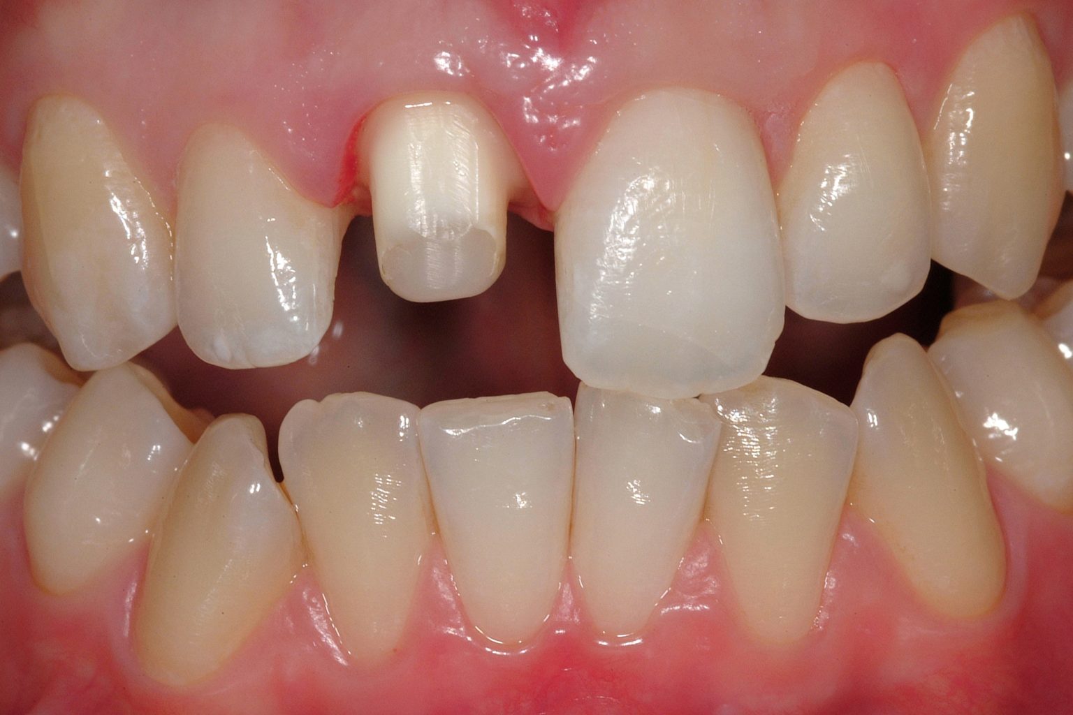 Ceramic crown for a complicated tooth fracture - Dentistry
