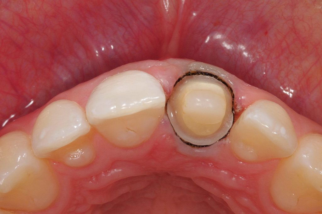 Ceramic crown for a complicated tooth fracture - Dentistry