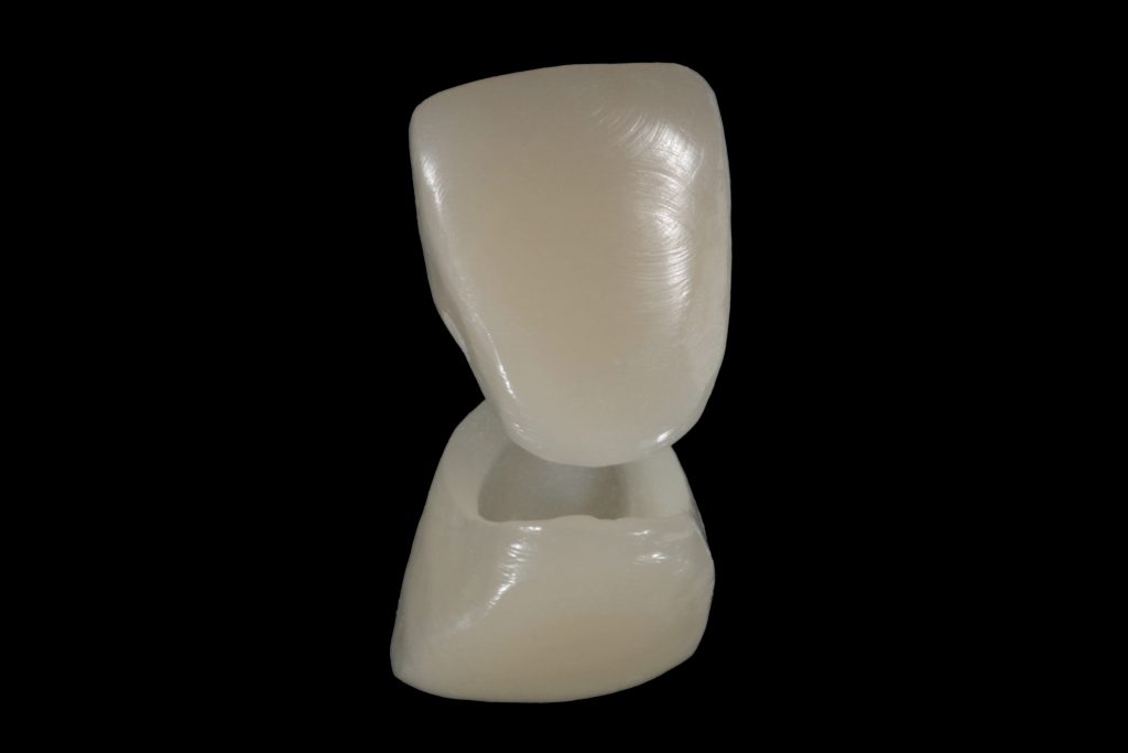 Ceramic crown for a complicated tooth fracture - Dentistry