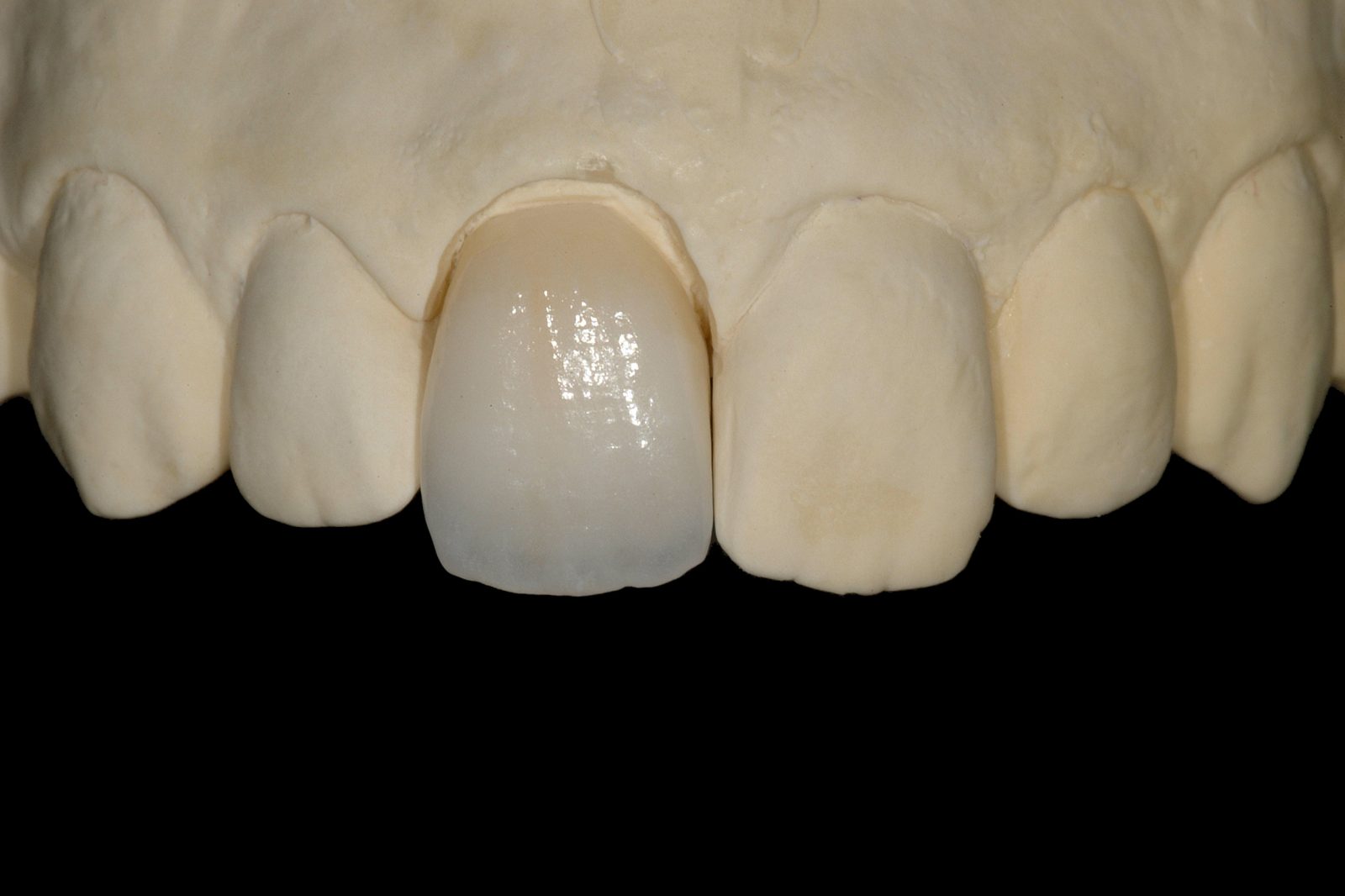 Ceramic Crown_013d - Dentistry.co.uk