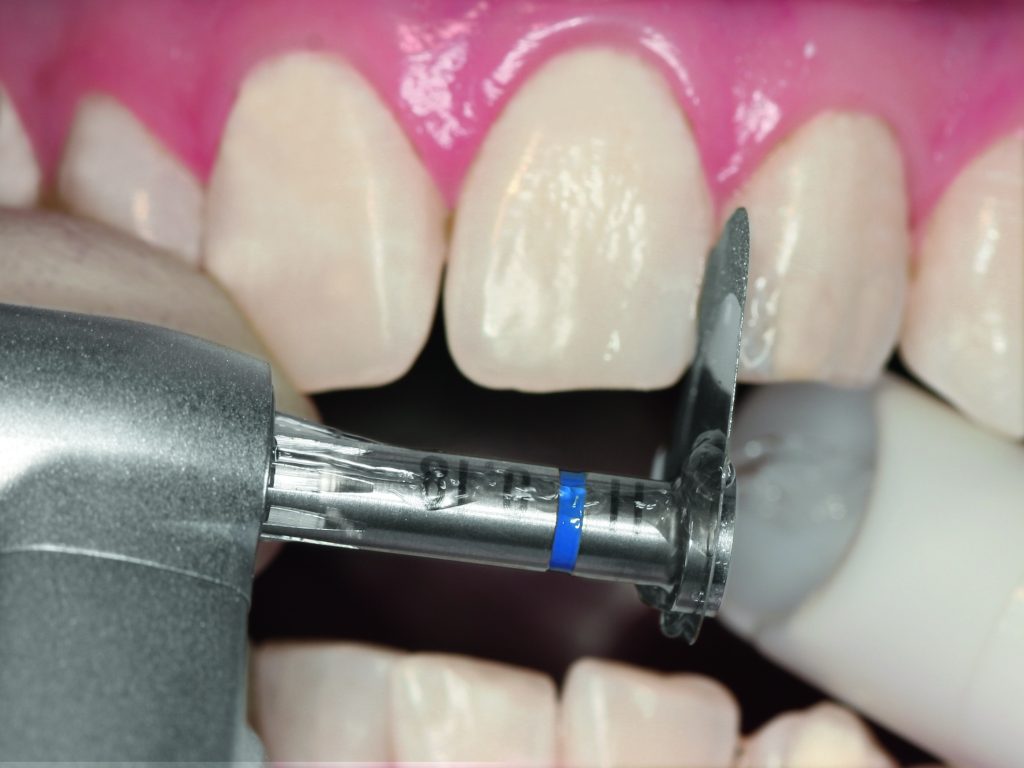 Greater safety during orthodontic stripping - Dentistry