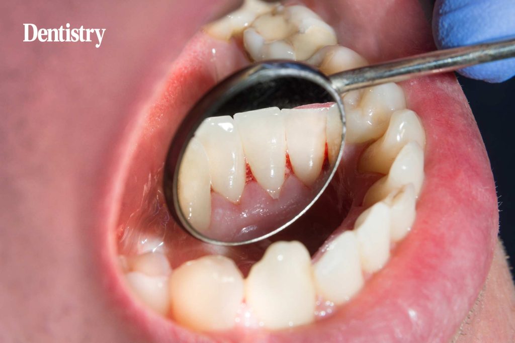 Biofilm and periodontal disease - Dentistry