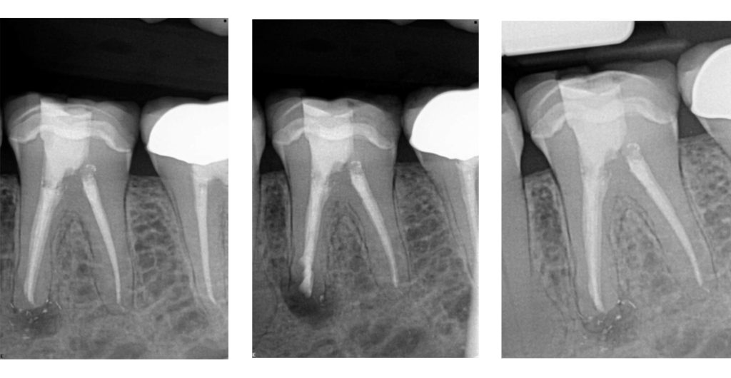 Endodontic microsurgery: a paradigm shift - Dentistry