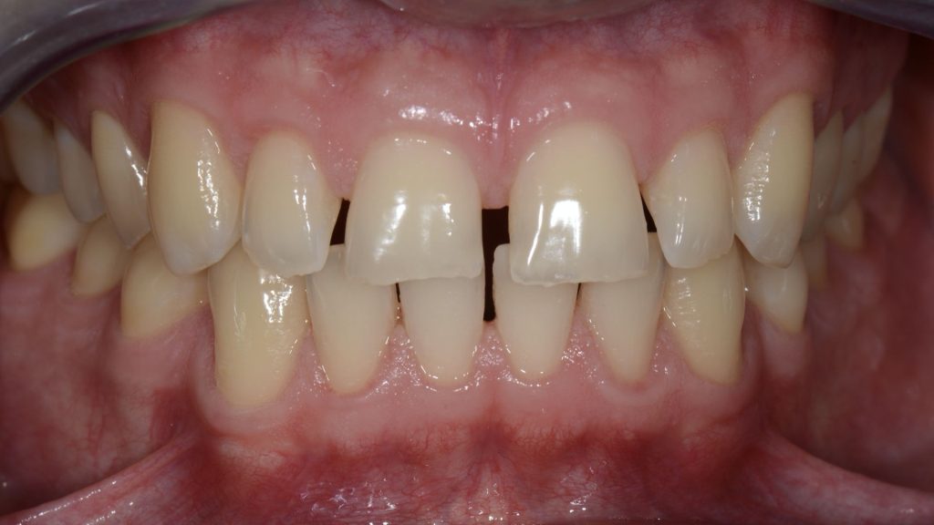 Injectable composites: quick fix or long-lasting solution? - Dentistry