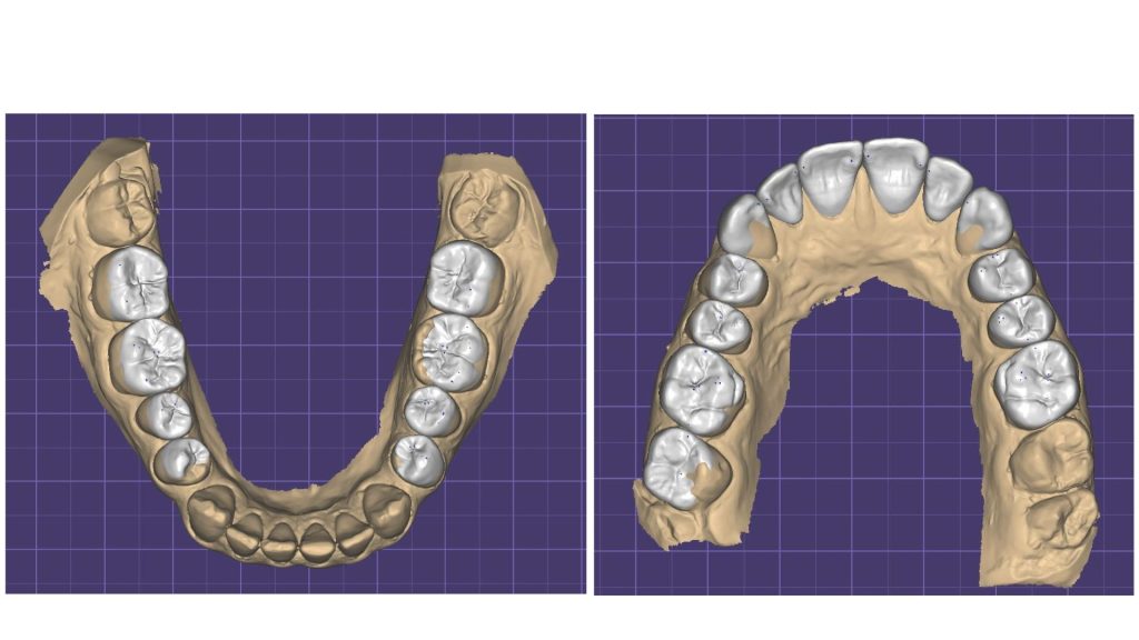 Injectable composites: quick fix or long-lasting solution? - Dentistry