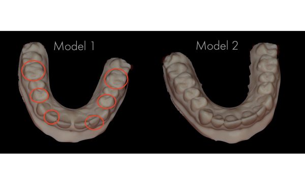 Injectable composites: quick fix or long-lasting solution? - Dentistry
