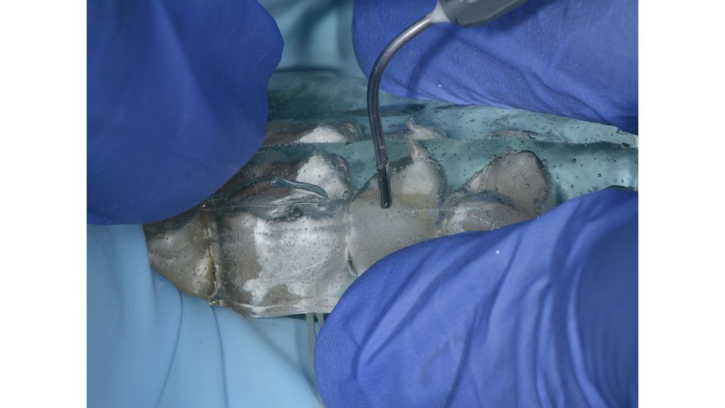 Injectable composites: quick fix or long-lasting solution? - Dentistry