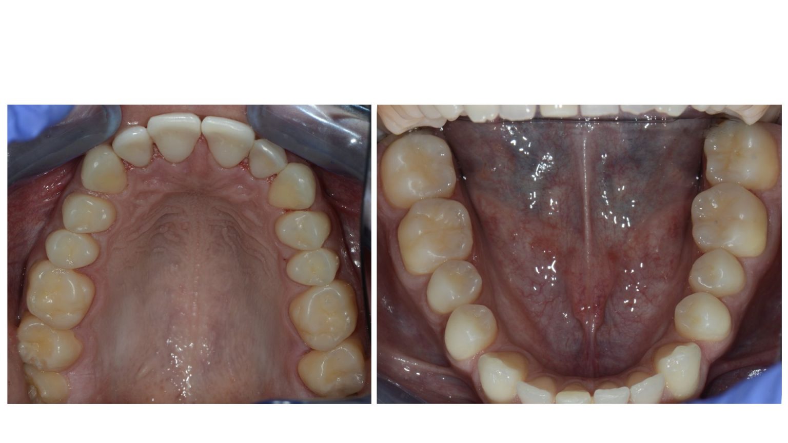 Injectable composites: quick fix or long-lasting solution? - Dentistry
