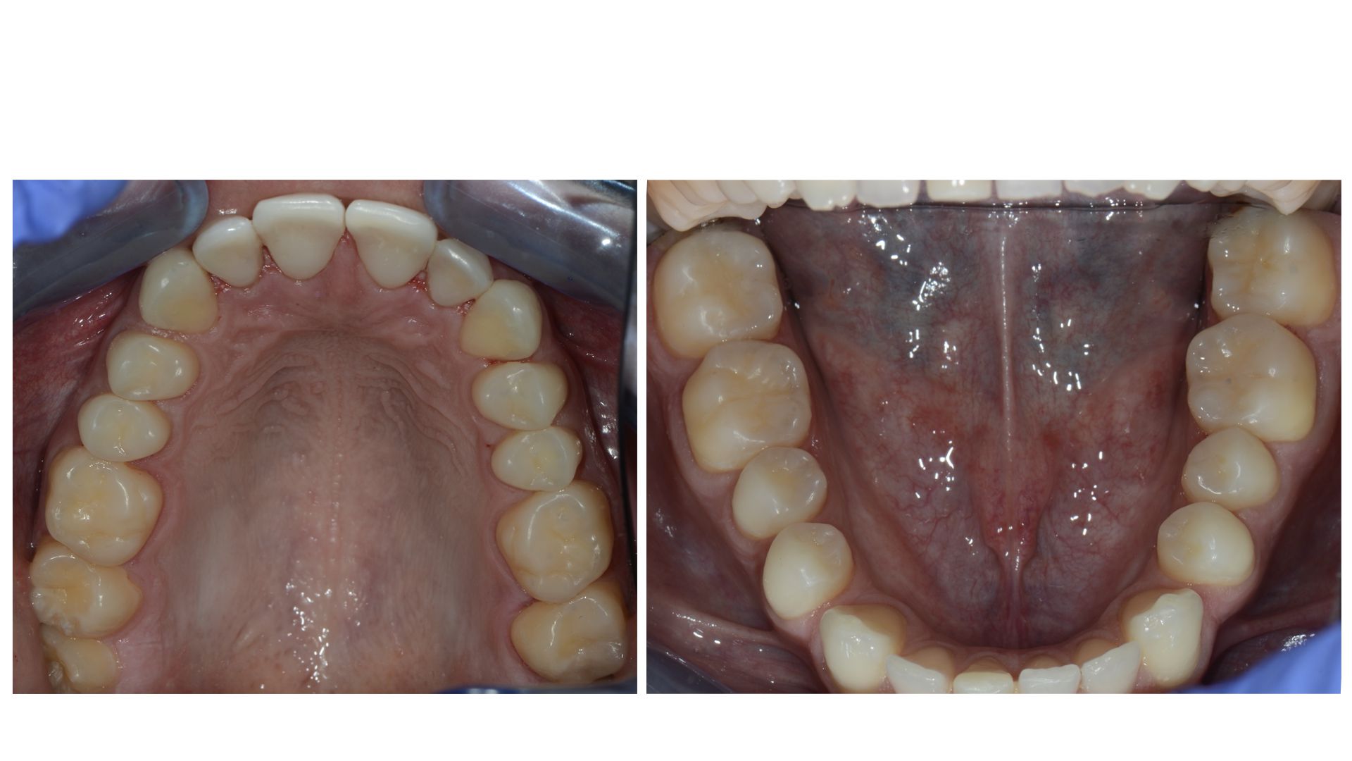 Injectable composites: quick fix or long-lasting solution? - Dentistry
