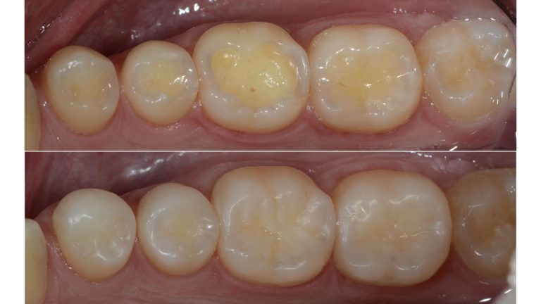 Injectable composites: quick fix or long-lasting solution? - Dentistry