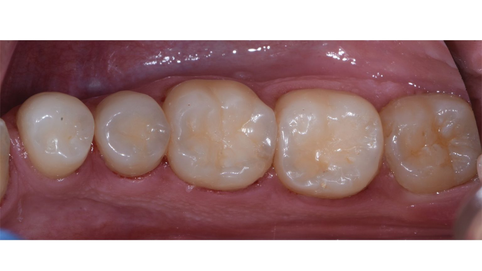 Injectable composites: quick fix or long-lasting solution? - Dentistry