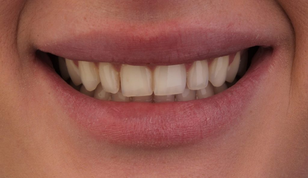 Injectable composites: quick fix or long-lasting solution? - Dentistry