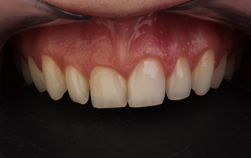 Injectable composites: quick fix or long-lasting solution? - Dentistry