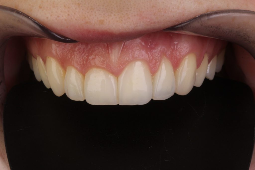 Injectable composites: quick fix or long-lasting solution? - Dentistry