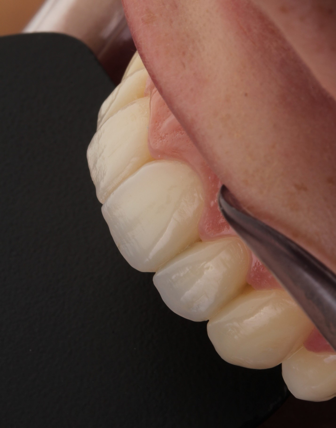 Injectable composites: quick fix or long-lasting solution? - Dentistry