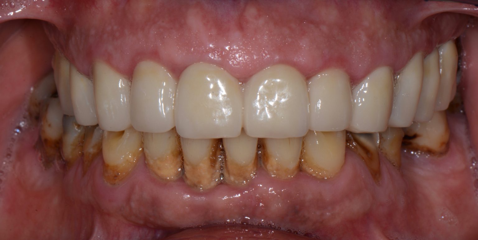 Injectable composites: quick fix or long-lasting solution? - Dentistry