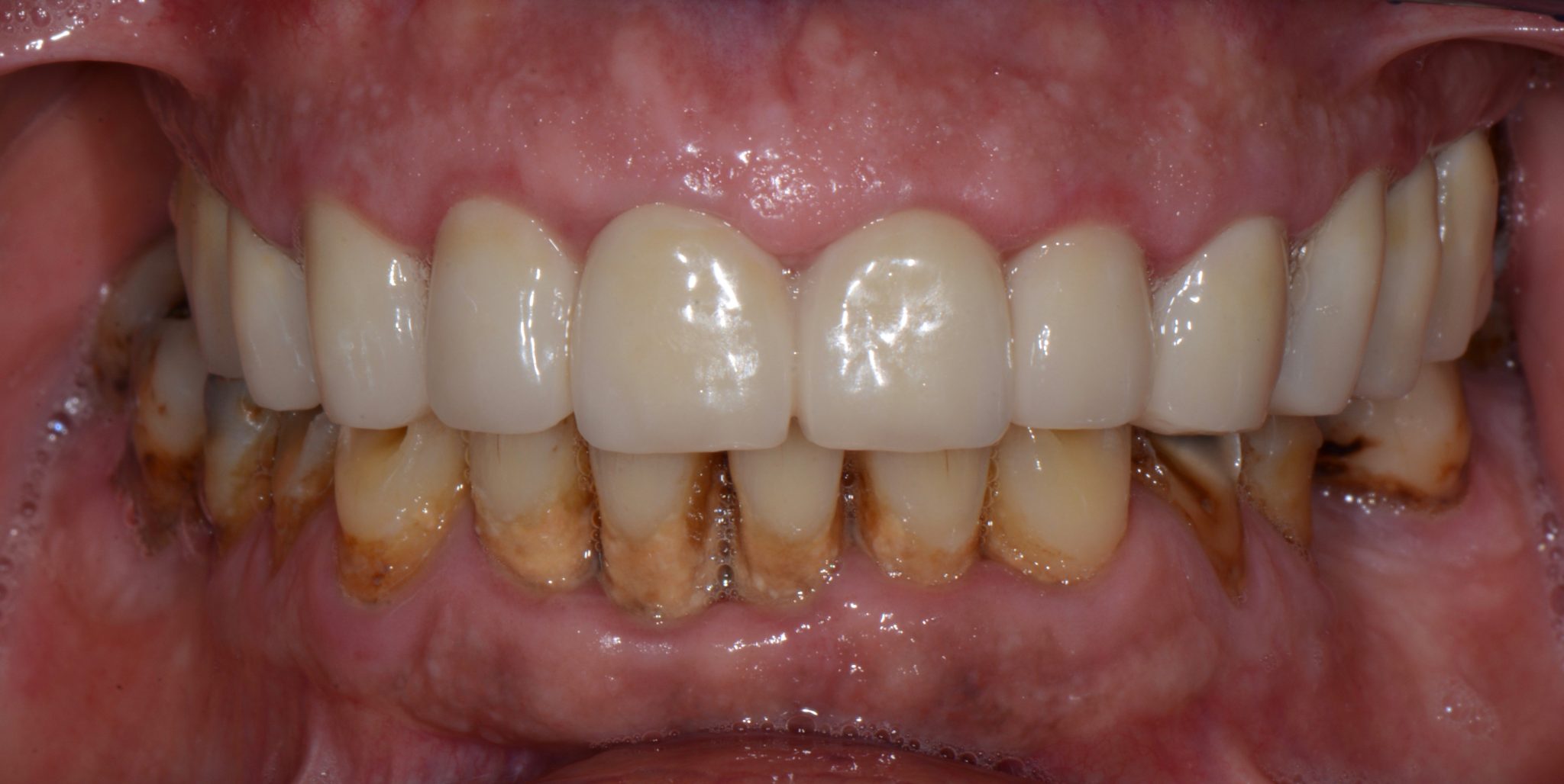 Injectable composites: quick fix or long-lasting solution? - Dentistry