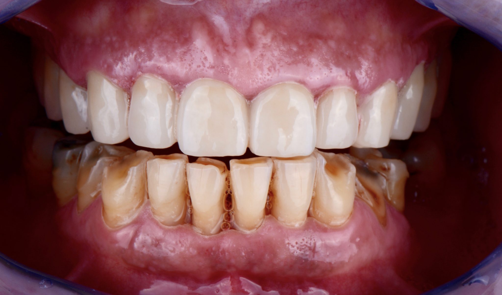 Injectable composites: quick fix or long-lasting solution? - Dentistry