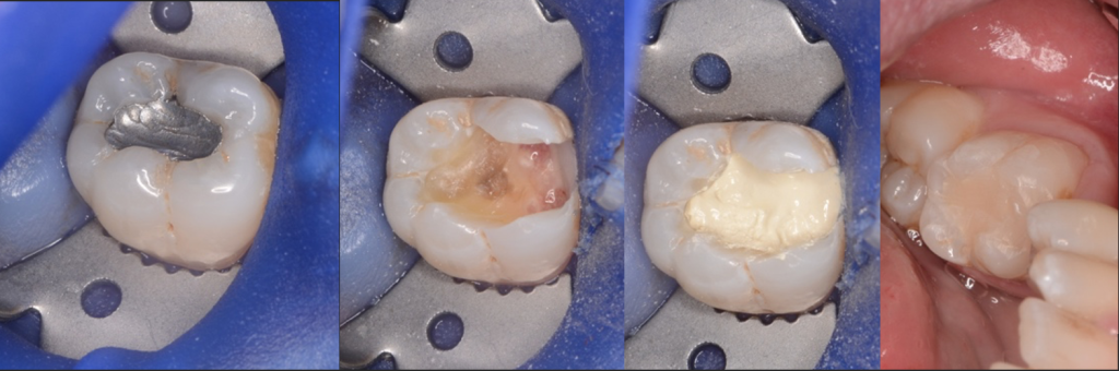 Endodontics 101 – Hydraulic cements - Dentistry