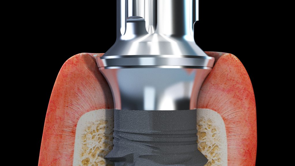 Tissue level implants – what are the benefits? - Dentistry