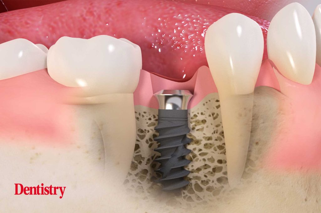 Tissue level implants – what are the benefits? - Dentistry