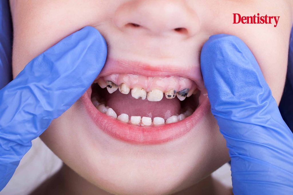 Almost 80% in healthcare report higher child tooth decay - Dentistry