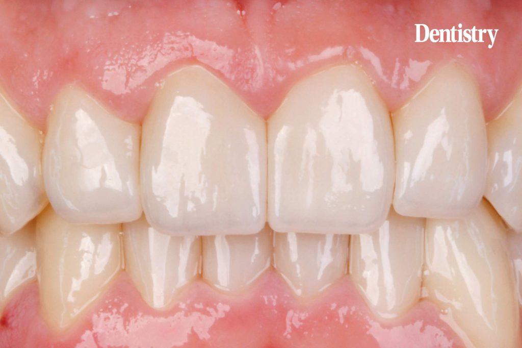 Ultra-thin Prettau Skin veneers - Dentistry