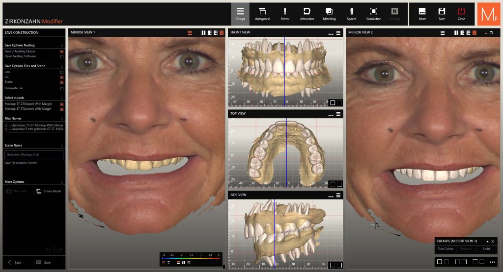 A safeguarded approach for a complete restoration - Dentistry