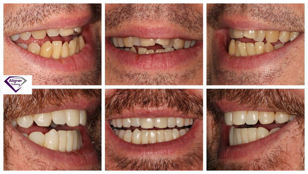 Clear aligner therapy with minimum maintenance - Dentistry
