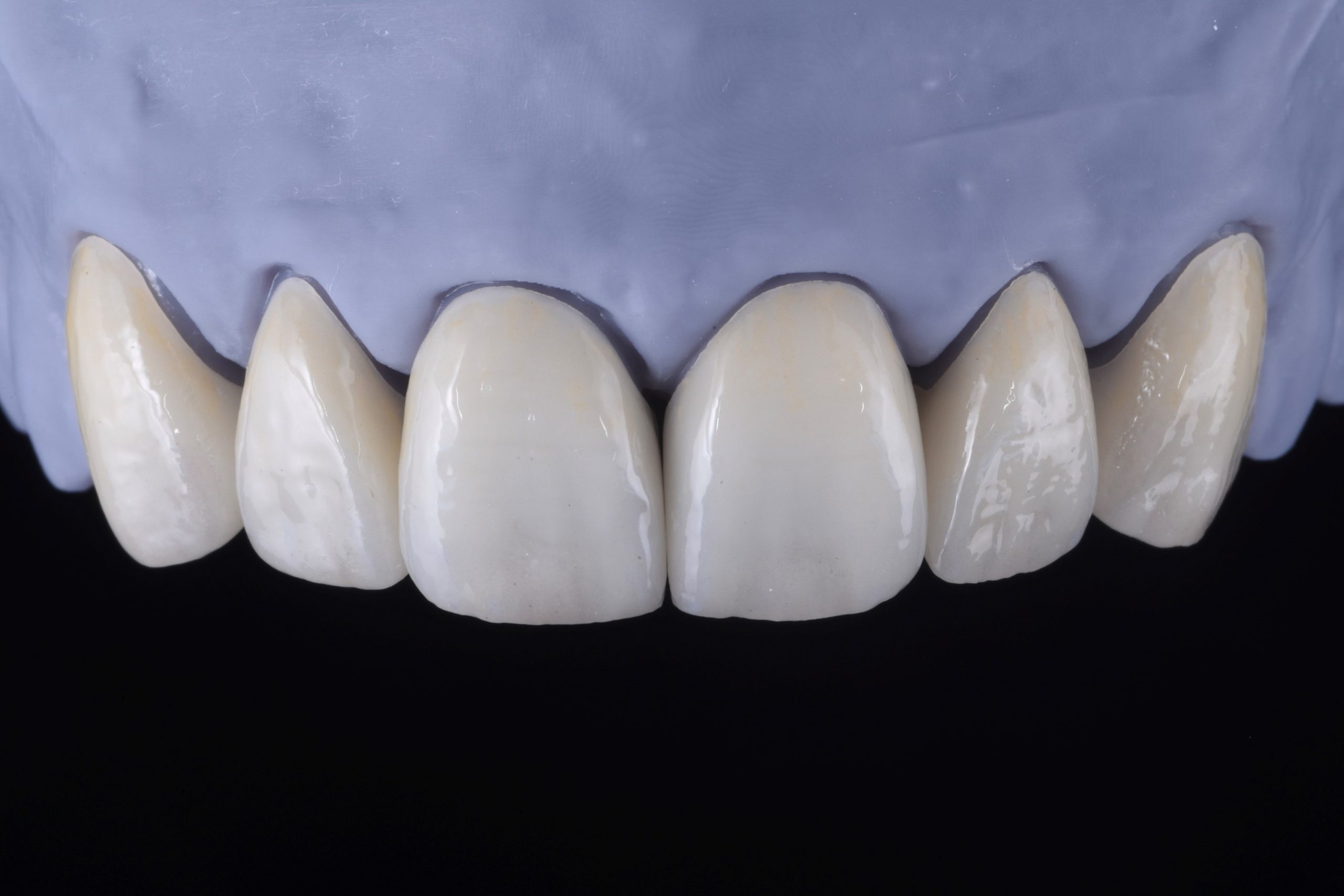 Figure 14_Final restoration_1 - Dentistry.co.uk
