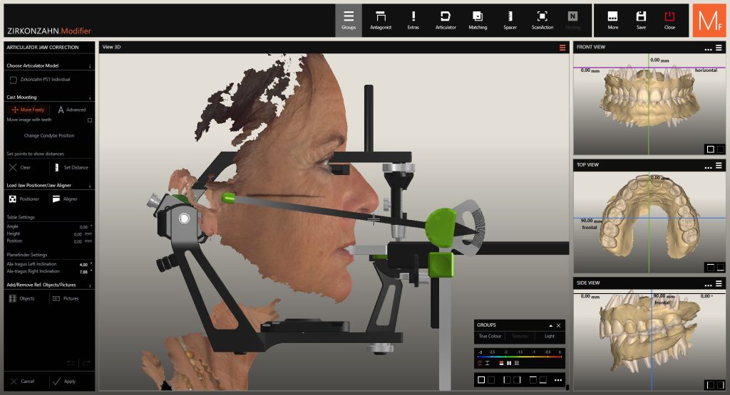 Treatment of tooth wear with zirconia crowns - Dentistry
