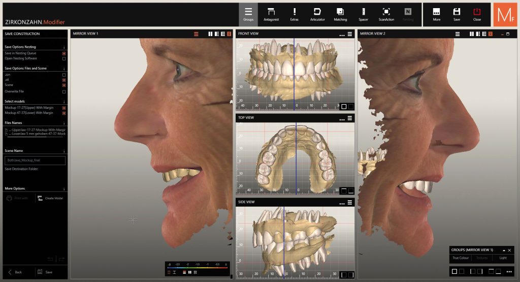 Treatment of tooth wear with zirconia crowns - Dentistry