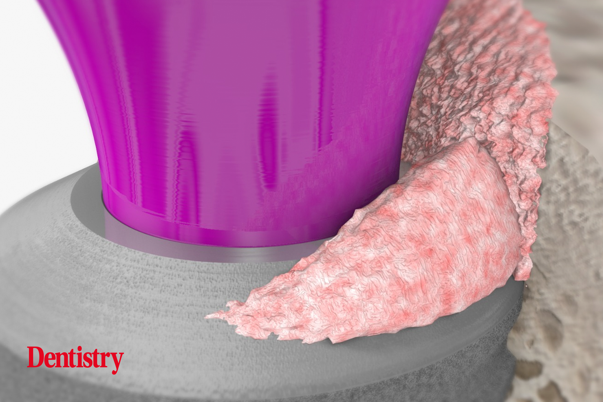 Bone Growth Concept – beyond platform-switch - Dentistry