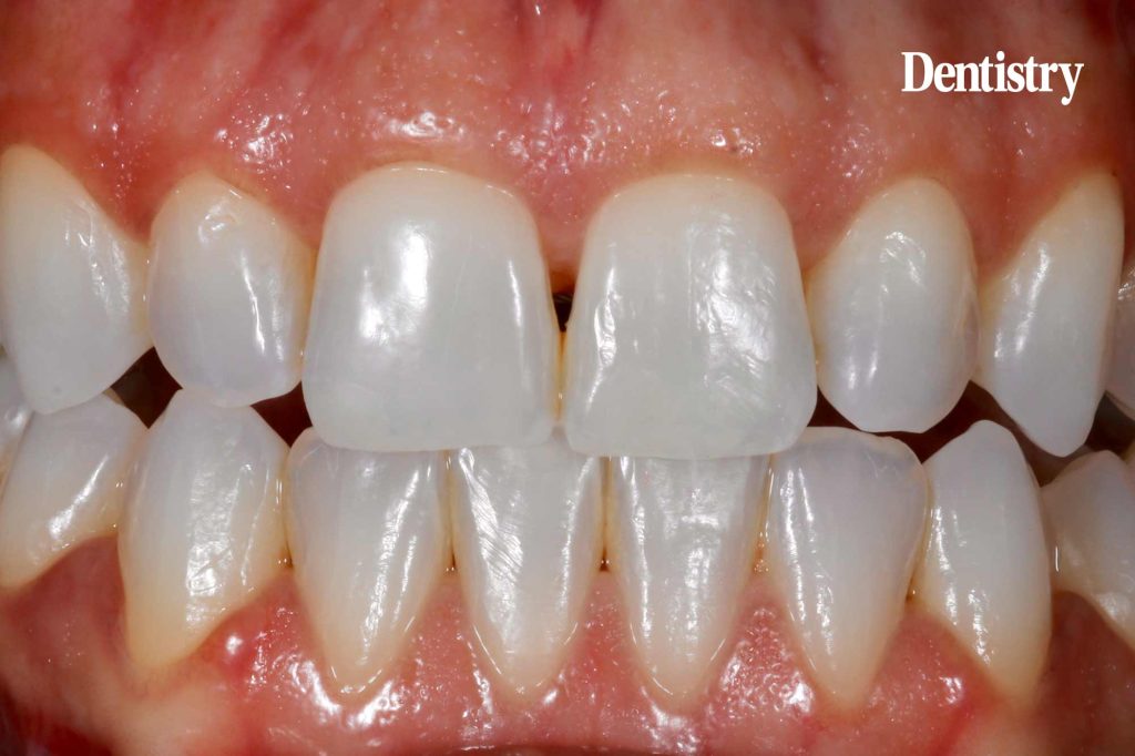 Producing a minimally invasive, aesthetic outcome - Dentistry