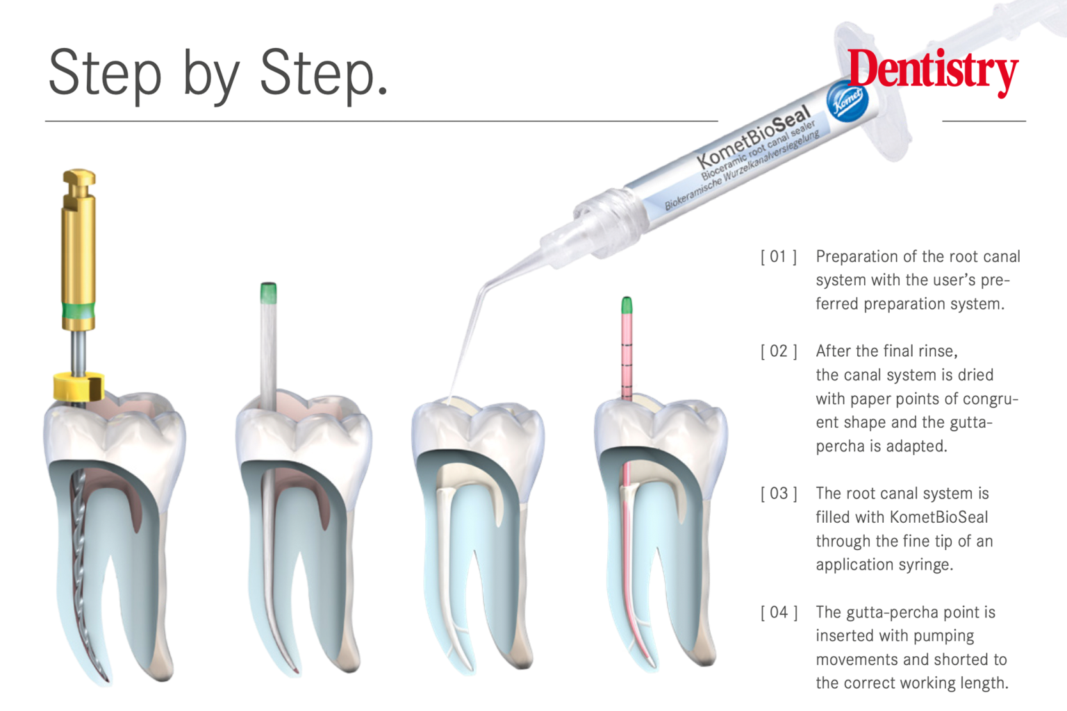 KometBioSeal – the new bioceramic root filling sealer - Dentistry