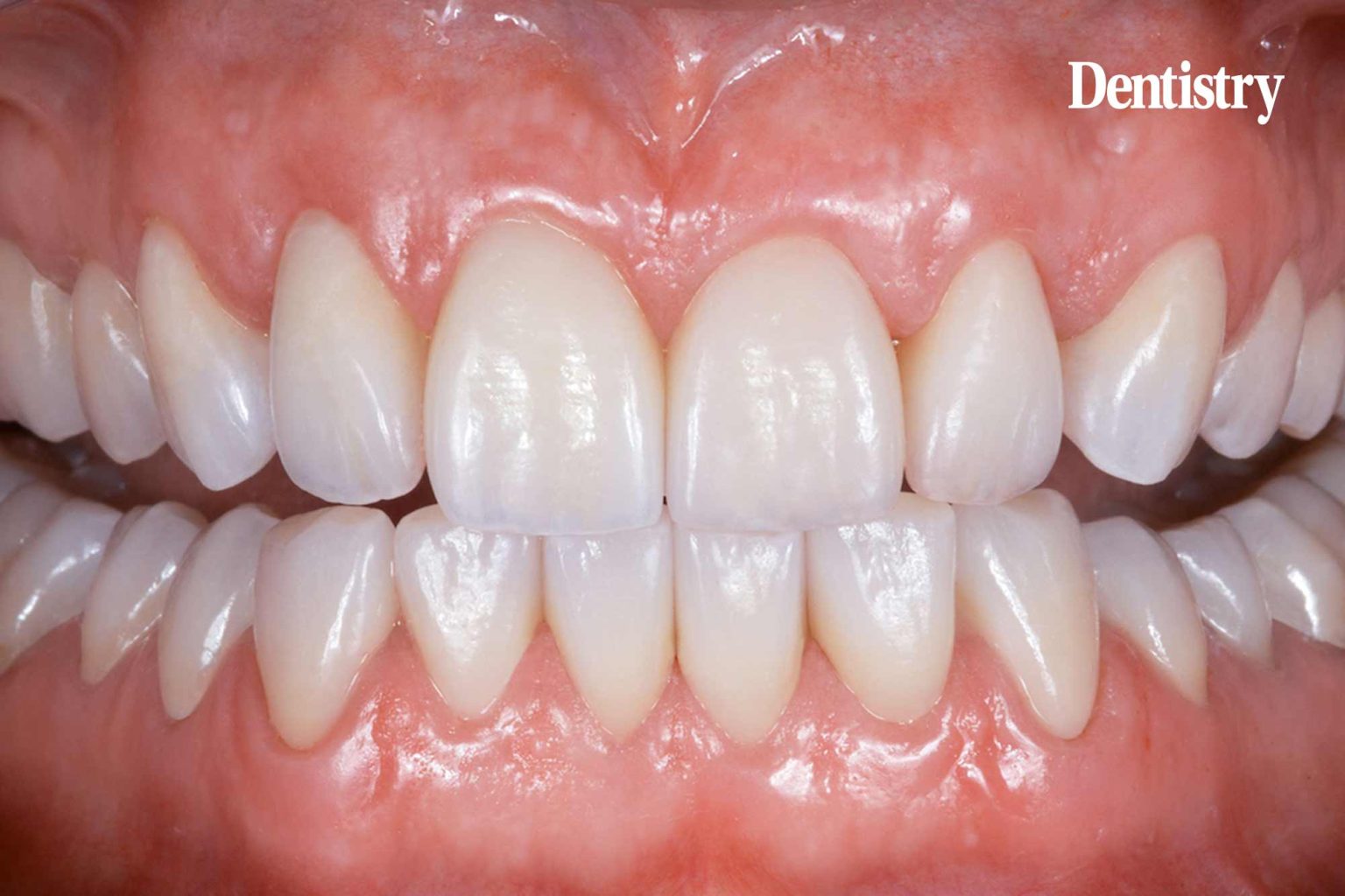 Treatment of tooth wear with zirconia crowns - Dentistry