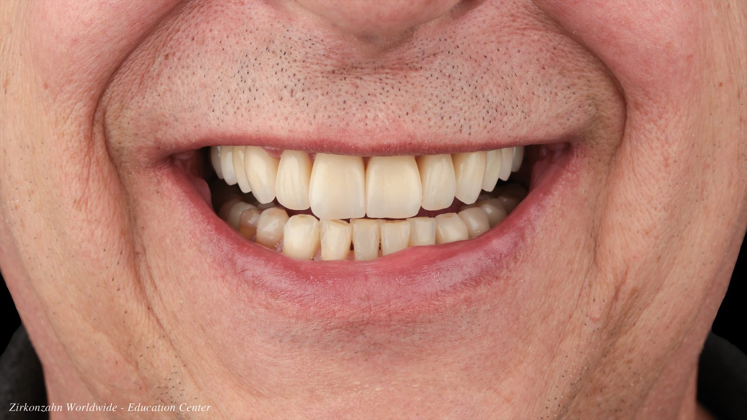 Single crowns made of Prettau 3 Dispersive zirconia - Dentistry