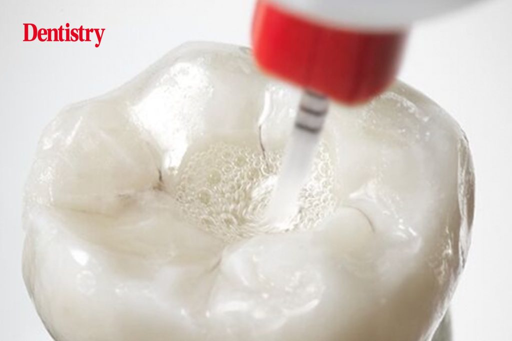 The smart solution for root canal irrigation - Dentistry