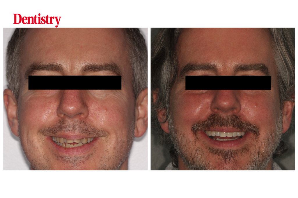 Achieving a smile transformation with Invisalign - Dentistry