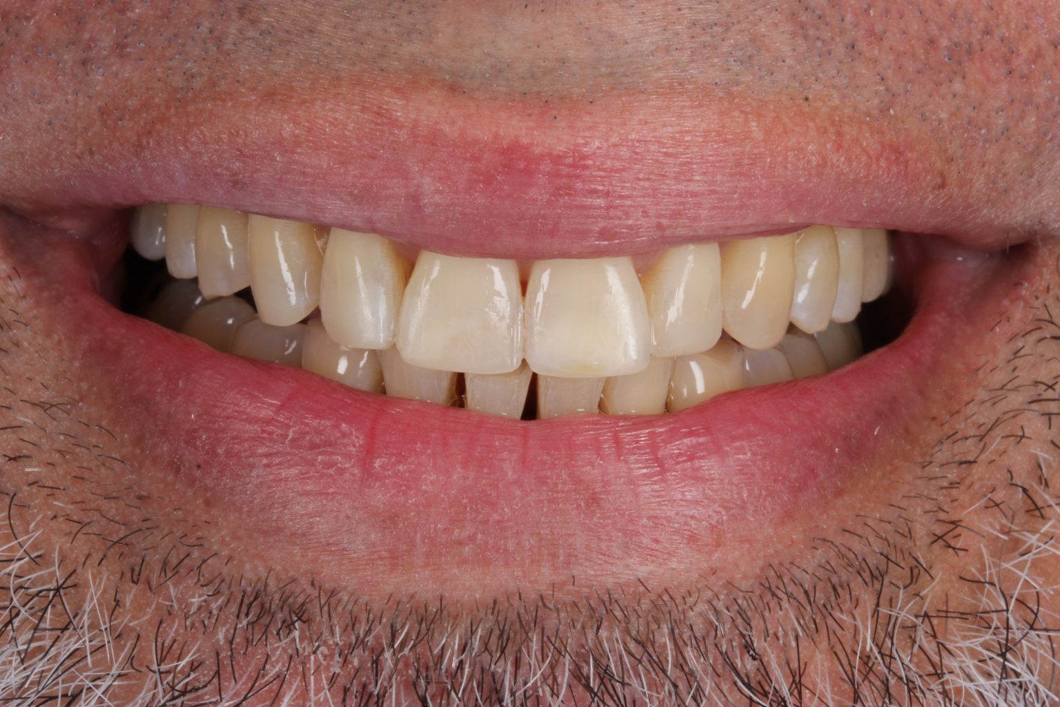 Patient delighted with 'age-defying' composite bonding - Dentistry