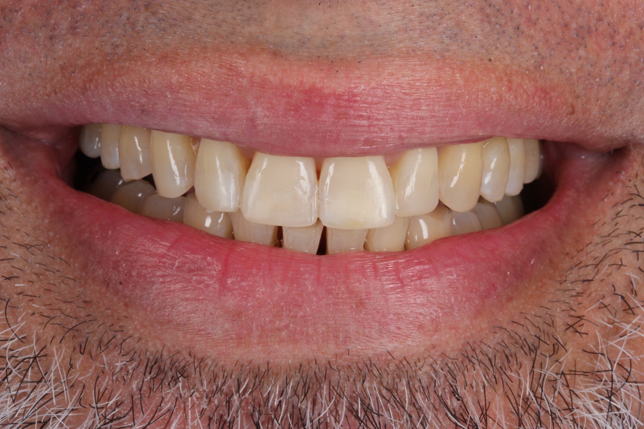 Patient delighted with 'age-defying' composite bonding - Dentistry