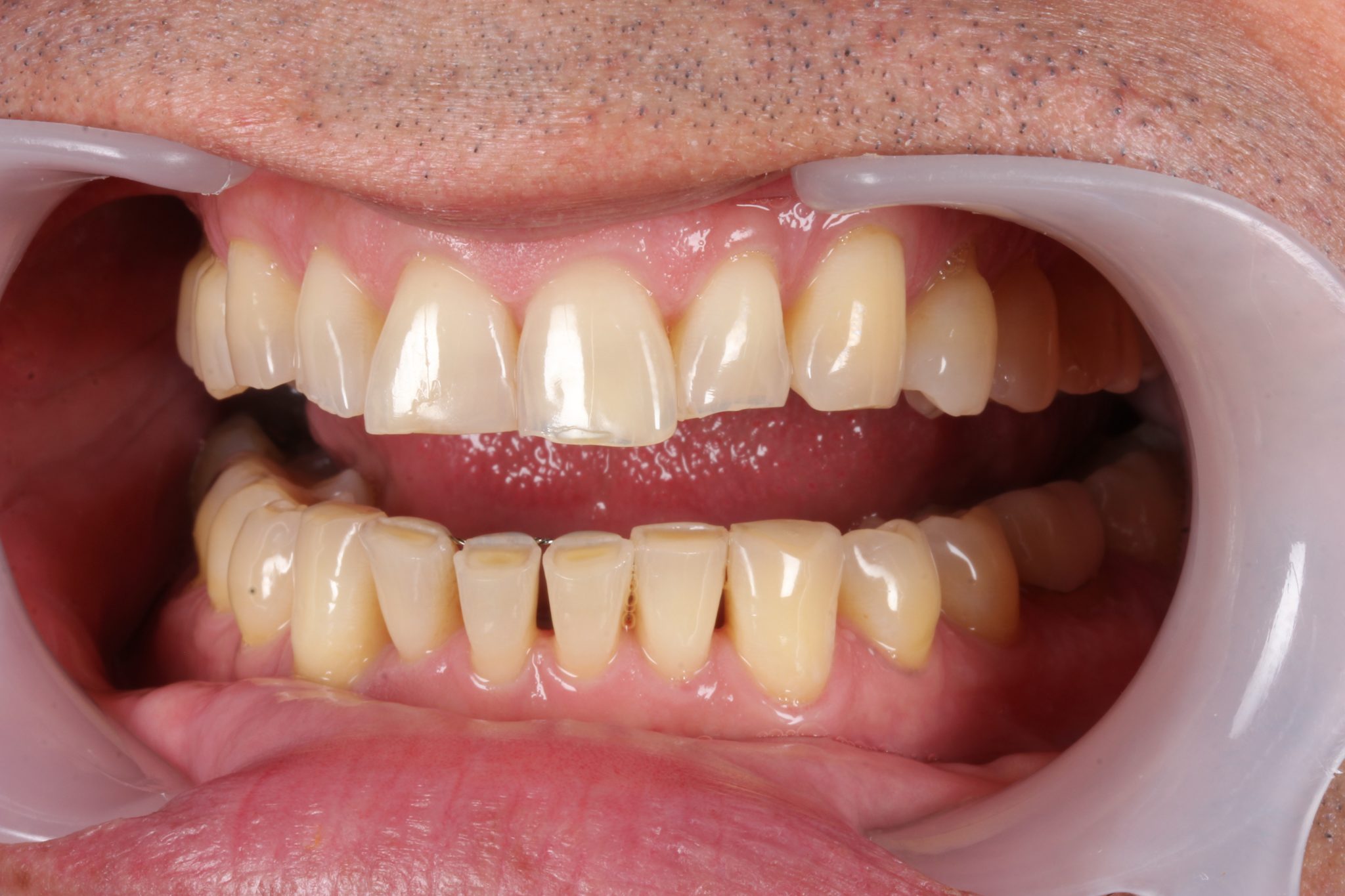 Patient delighted with 'age-defying' composite bonding - Dentistry