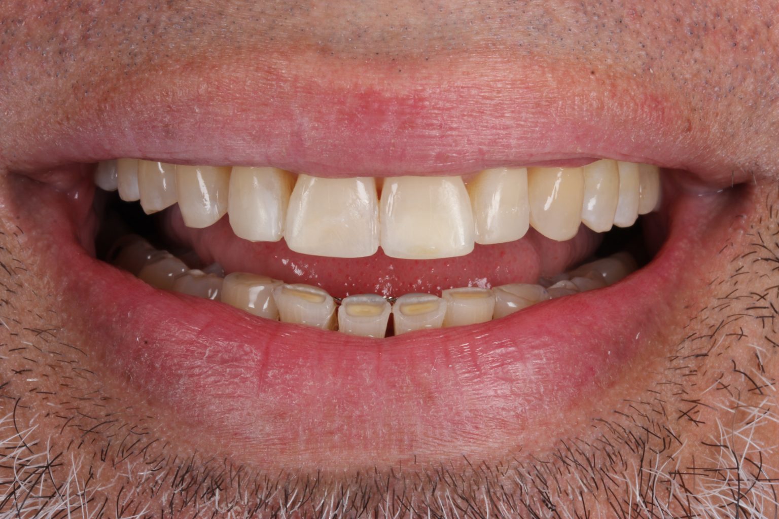 Patient delighted with 'age-defying' composite bonding - Dentistry