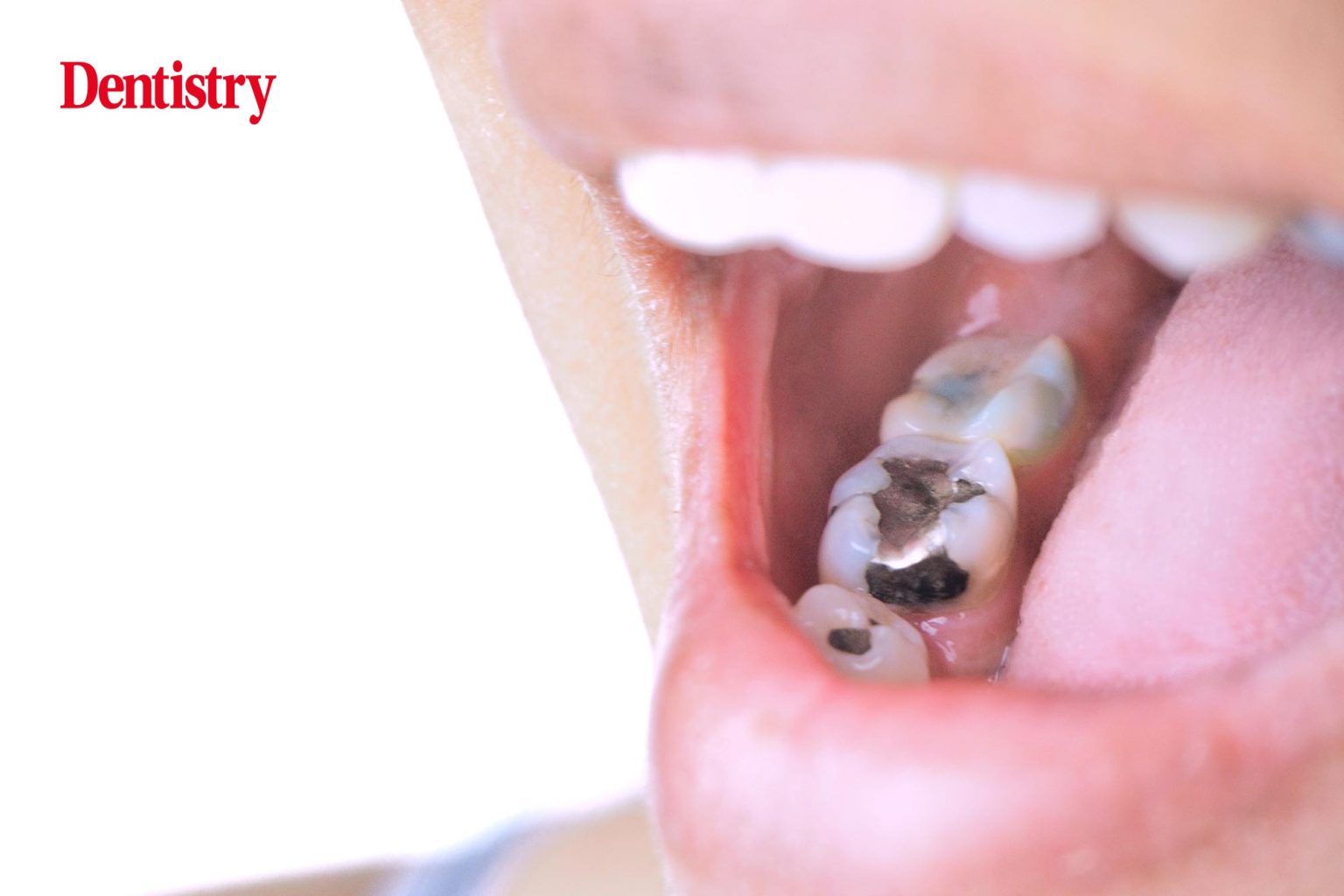 European Parliament votes to ban dental amalgam - Dentistry